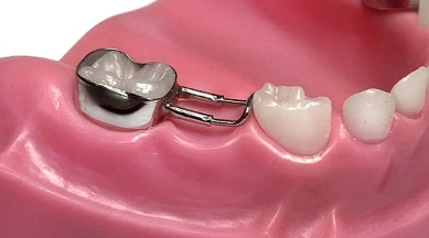 Pediatric Space Maintainers | Hilgers Pediatric Dentistry