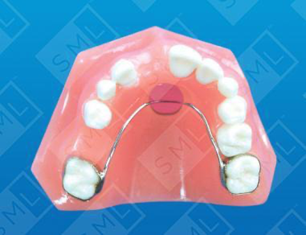 Pediatric Space Maintainers | Hilgers Pediatric Dentistry